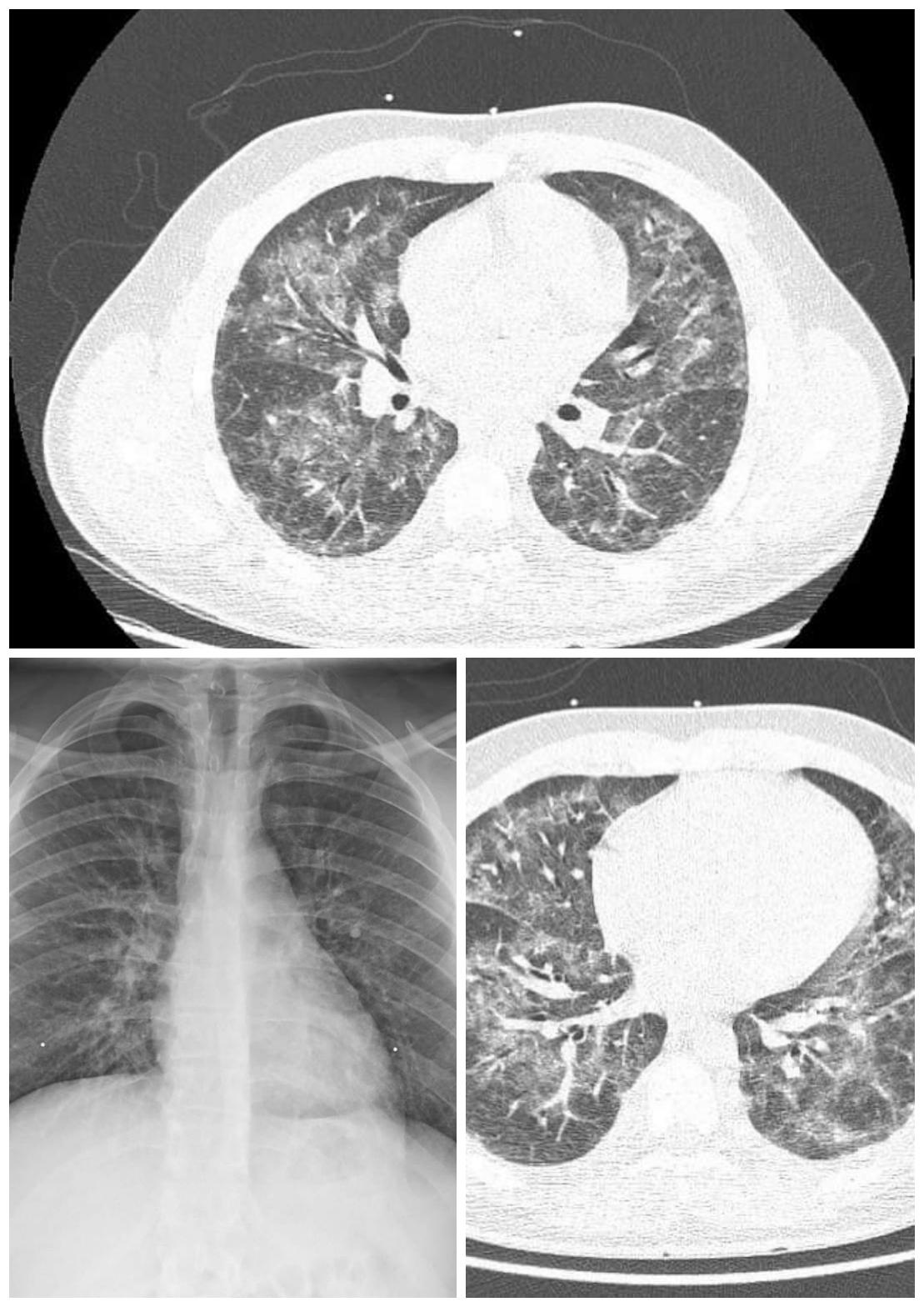 RefleqtMedia | Asa arata plamanii unui fumator de tigari electronice!